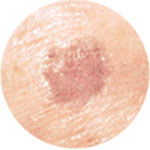 What Skin Cancer Looks Like | Skinmedix